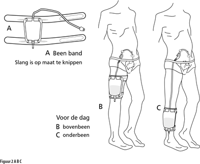 Suprapubische katheter - UMC Utrecht